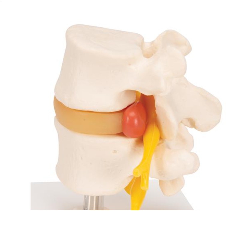 Dischi vertebrali lombari con ernia del disco - Colonna vertebrale ...