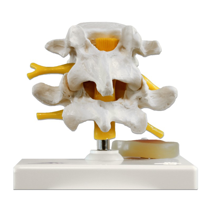 Dischi vertebrali lombari con ernia del disco - Colonna vertebrale ...